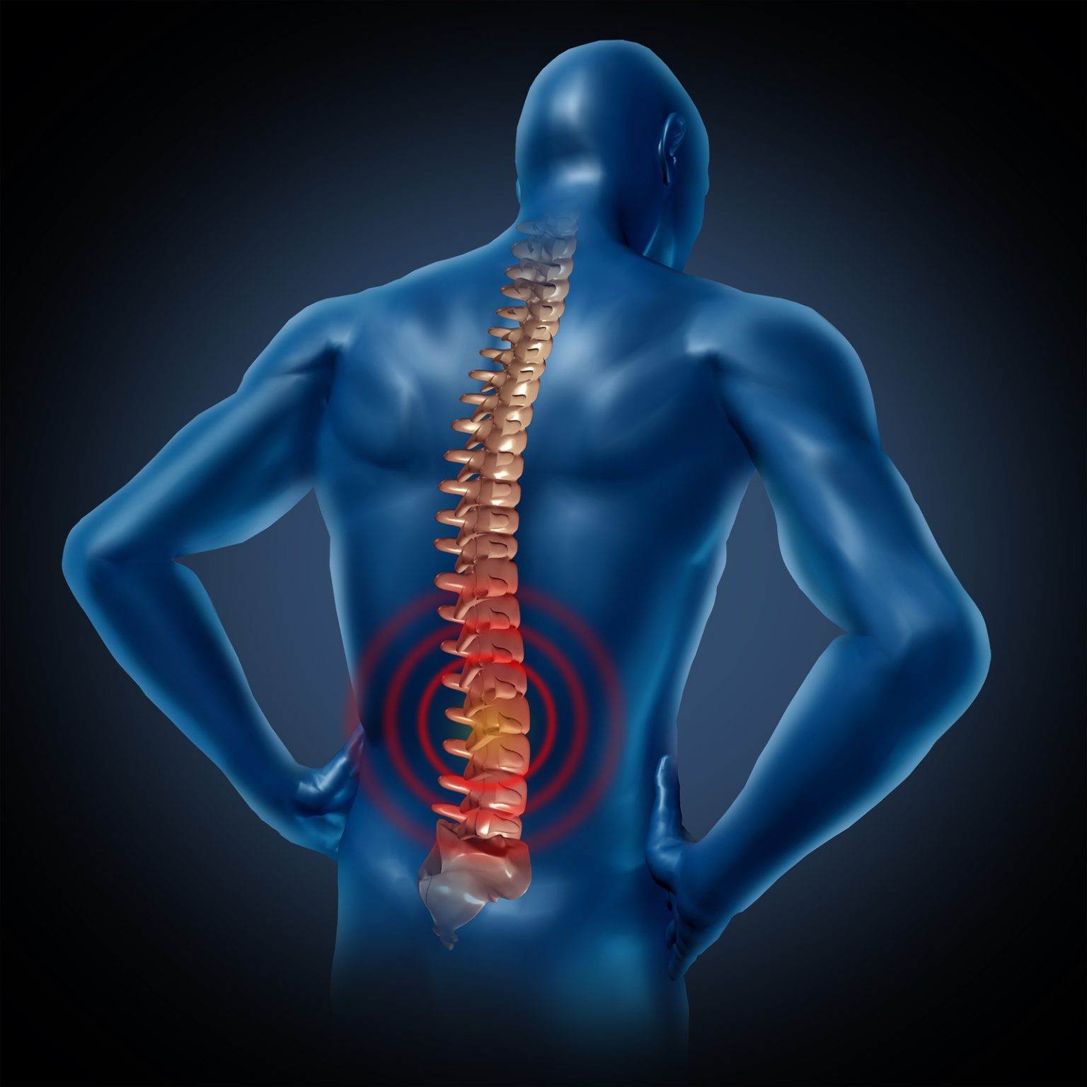 How Much Is a Bulging Disc Back Injury Lawsuit Worth in Maryland?